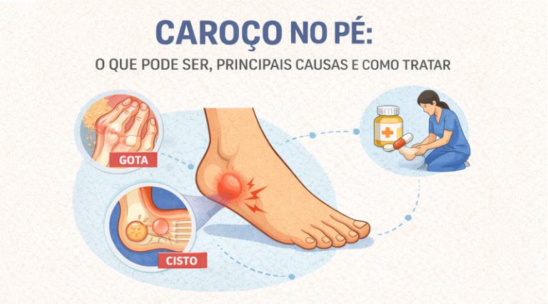 Caroço no Pé: O Que Pode Ser, Principais Causas e Como Tratar - Doctor ...